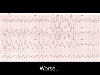Ecg in Toxicology | PDF