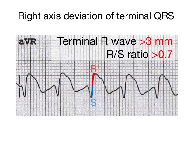 Ecg in Toxicology