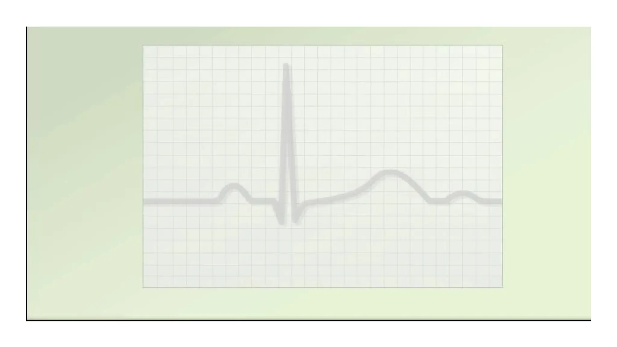 Basics of ECG Interpretation and identifying the abnormal ECG | PPTX