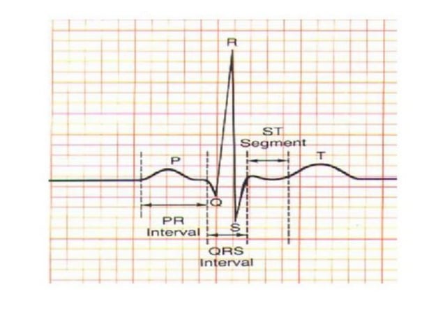 Ecg lead configuration | PDF