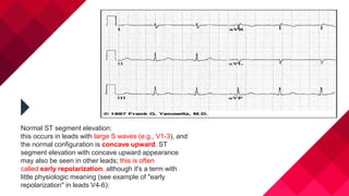 Characteristic of normal ECG | PPTX