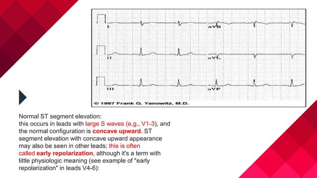 Characteristic of normal ECG | PPTX