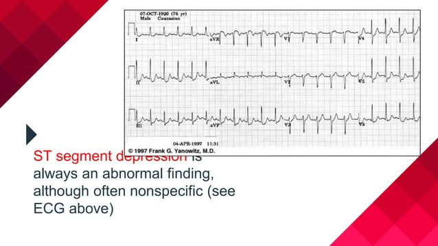 Characteristic of normal ECG | PPTX