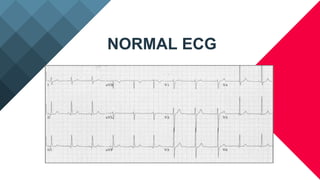 Characteristic of normal ECG | PPTX