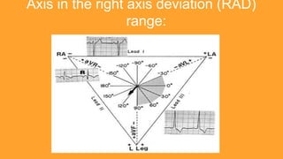 Method of ECG Interpretation | PPTX | Heart and Cardiovascular Diseases ...