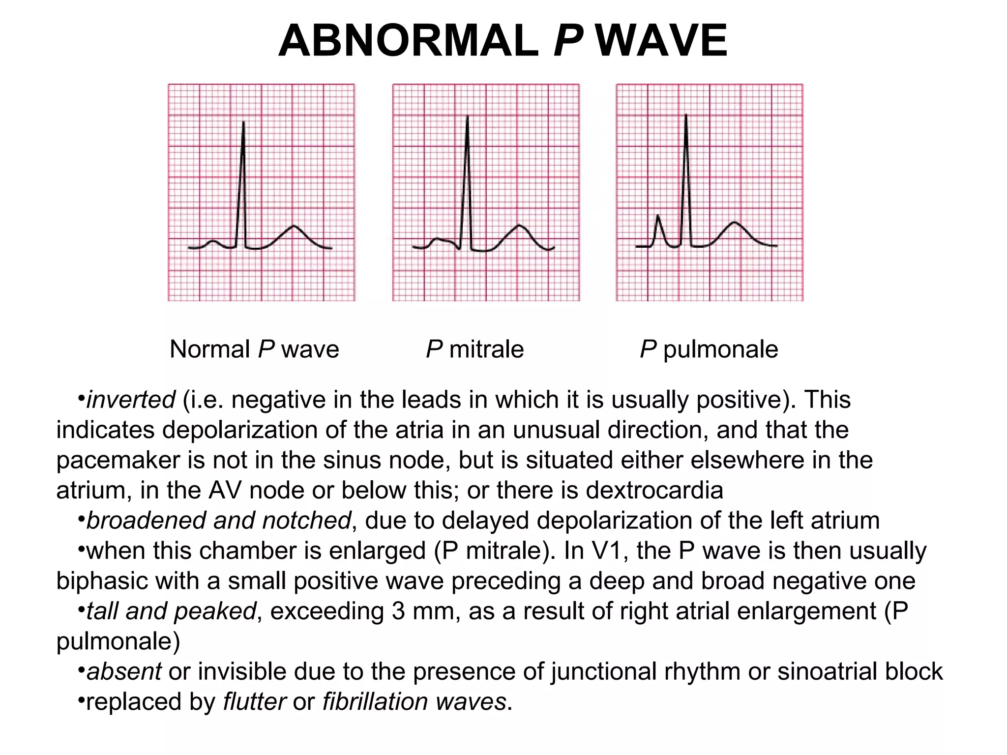 Ecg lecture | PPT