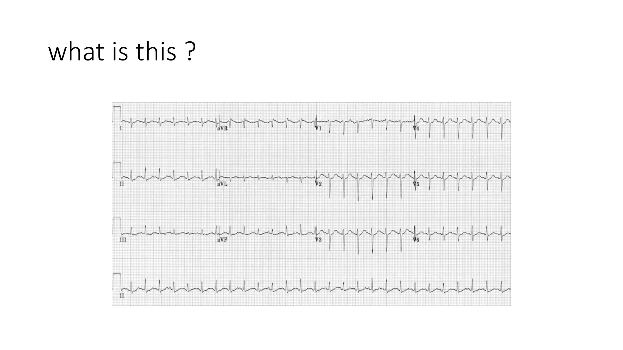 basic in ECG - physiology exam for medical student | PPT