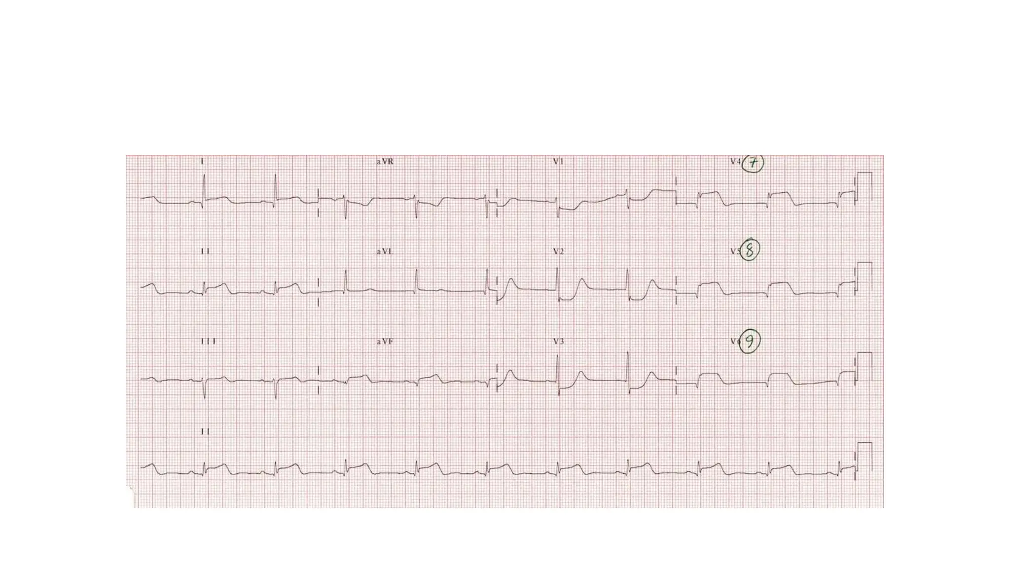 basic in ECG - physiology exam for medical student | PPT