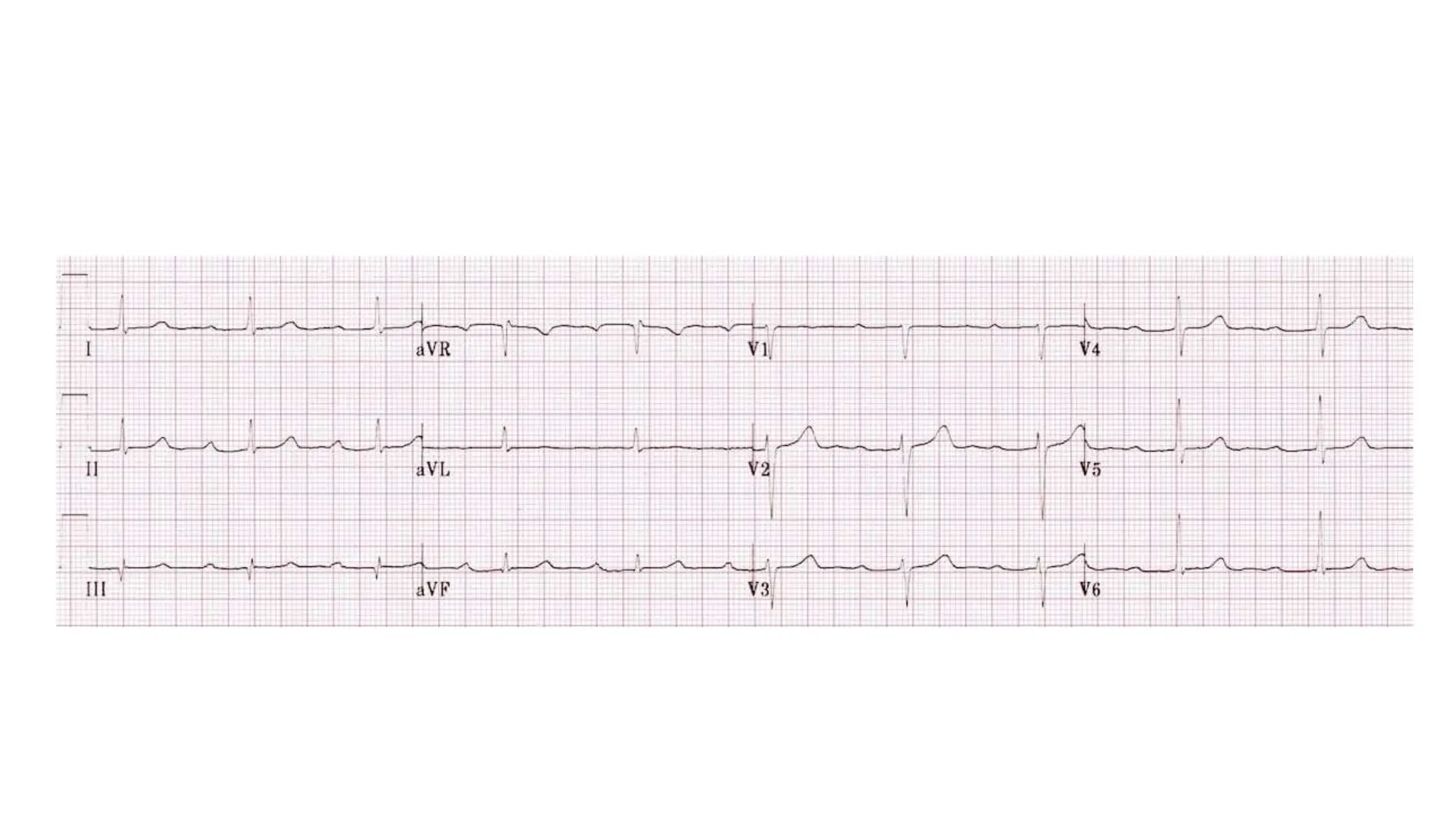 basic in ECG - physiology exam for medical student | PPT