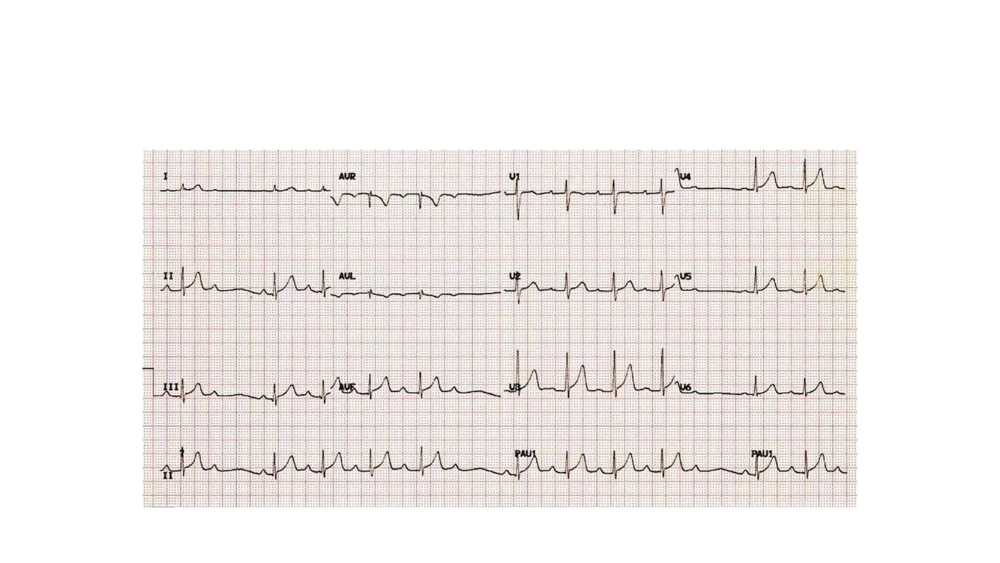 basic in ECG - physiology exam for medical student | PPT