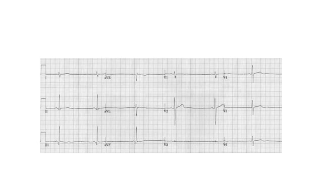 basic in ECG - physiology exam for medical student | PPT