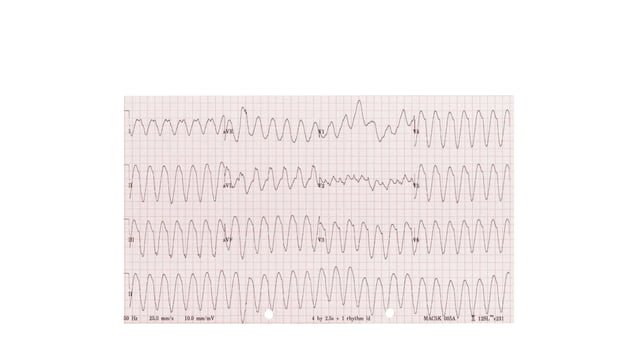 basic in ECG - physiology exam for medical student | PPT