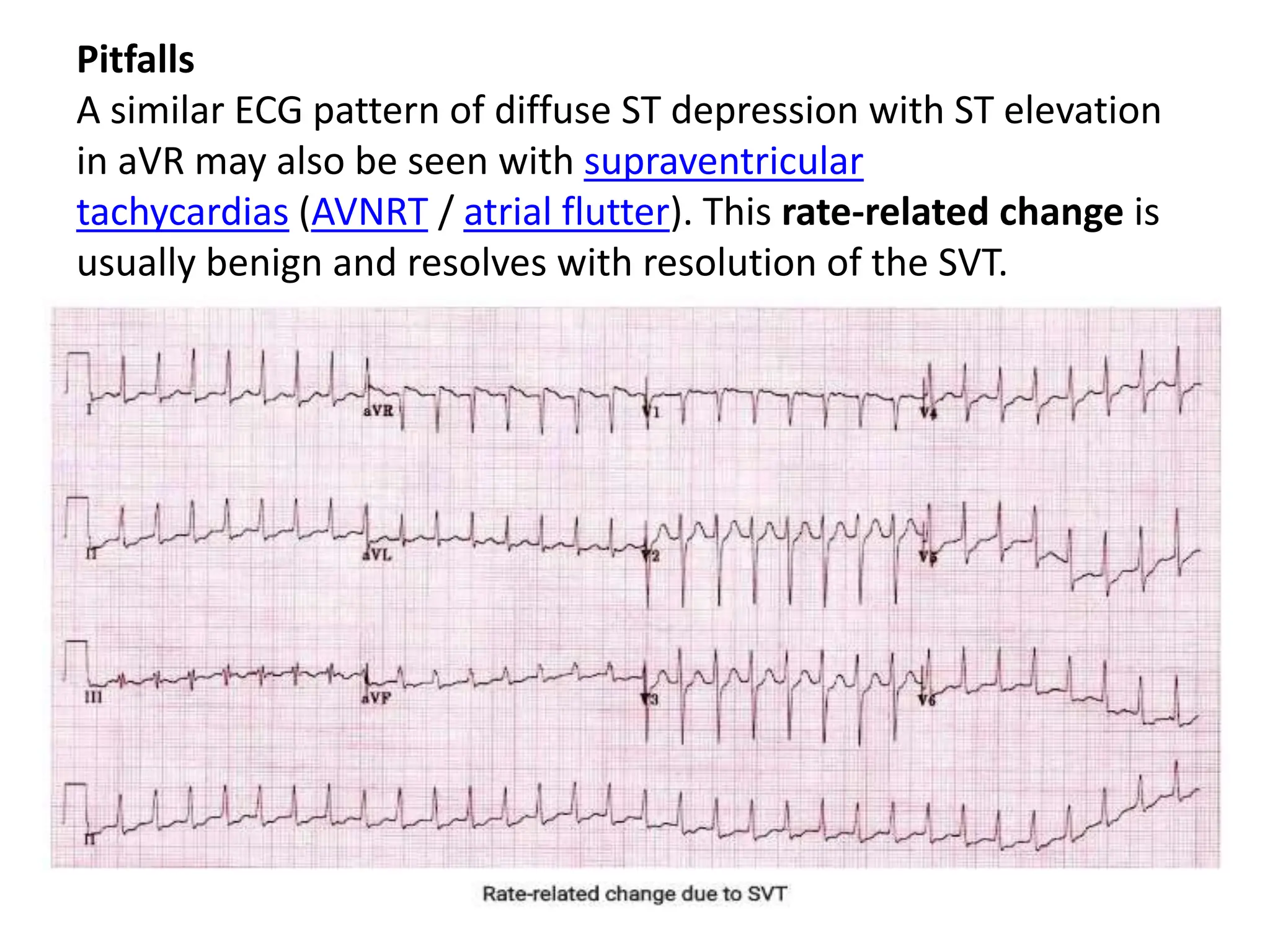 ECG life in the fastlane.pptx