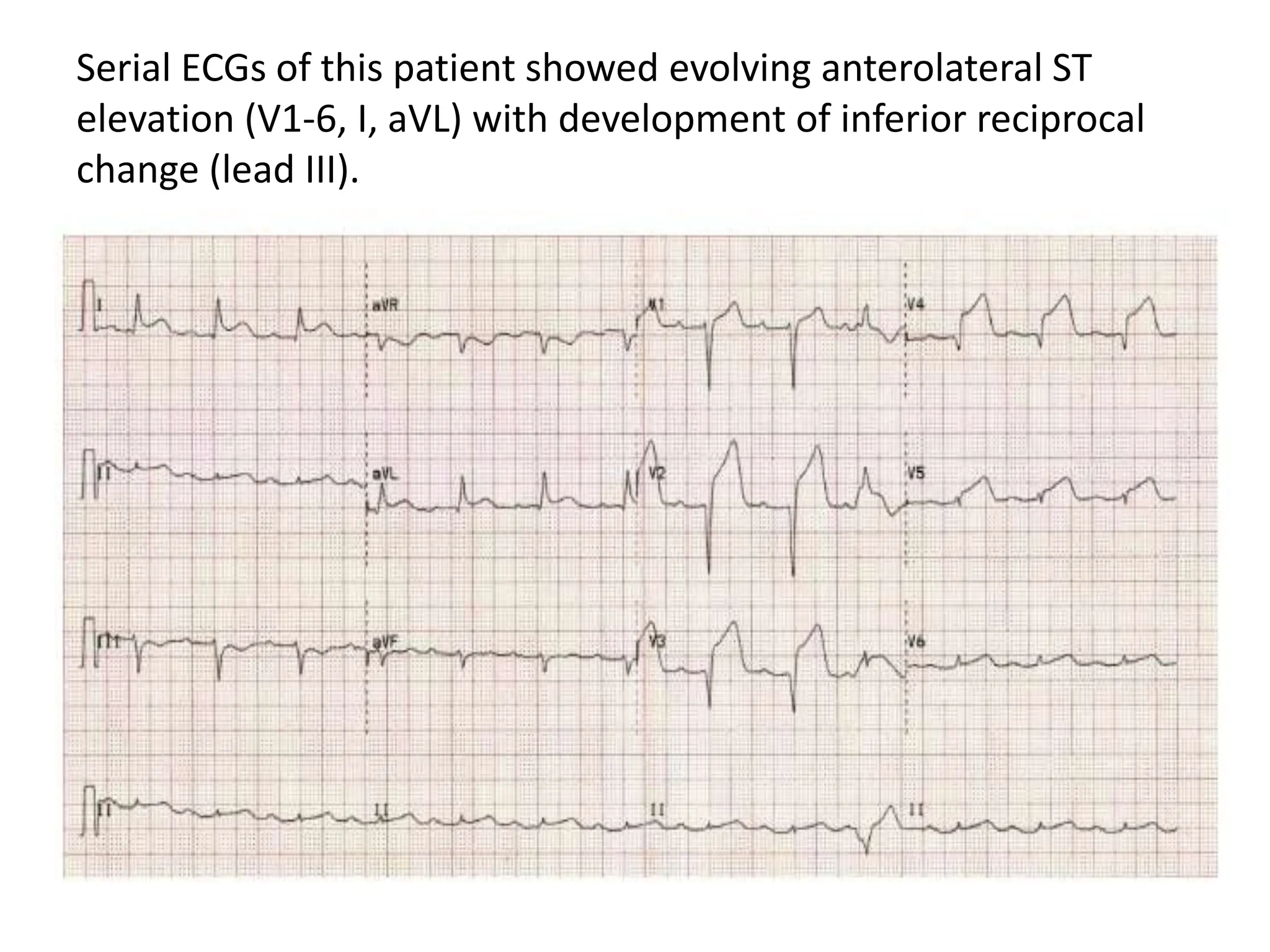 ECG life in the fastlane.pptx