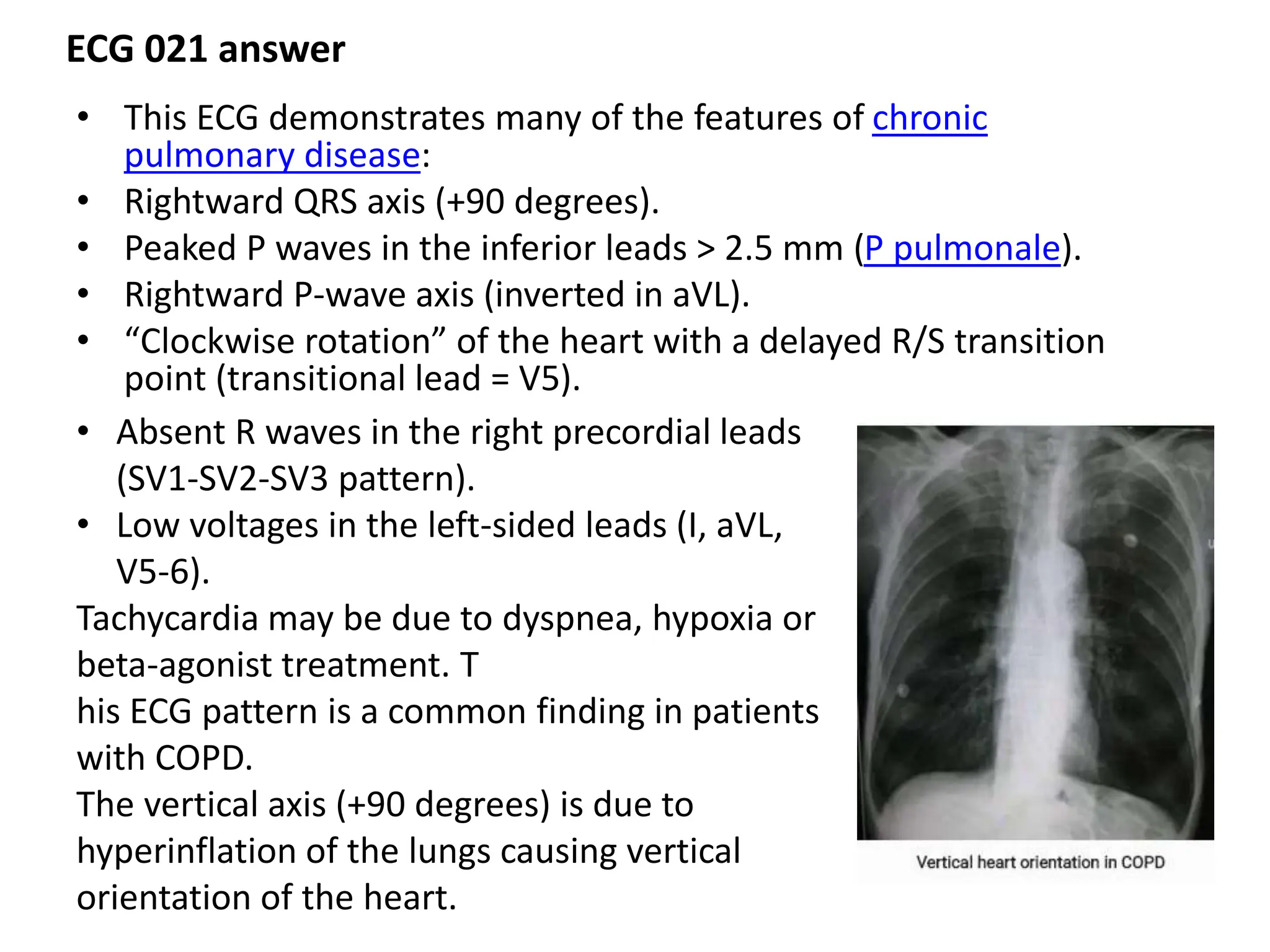 ECG life in the fastlane.pptx