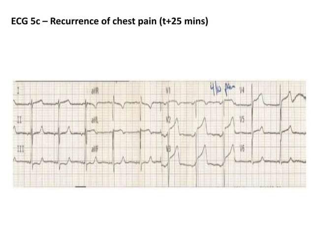 ECG life in the fastlane.pptx | Heart and Cardiovascular Diseases ...