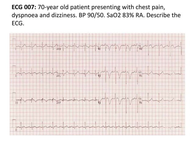 ECG life in the fastlane.pptx | Heart and Cardiovascular Diseases ...