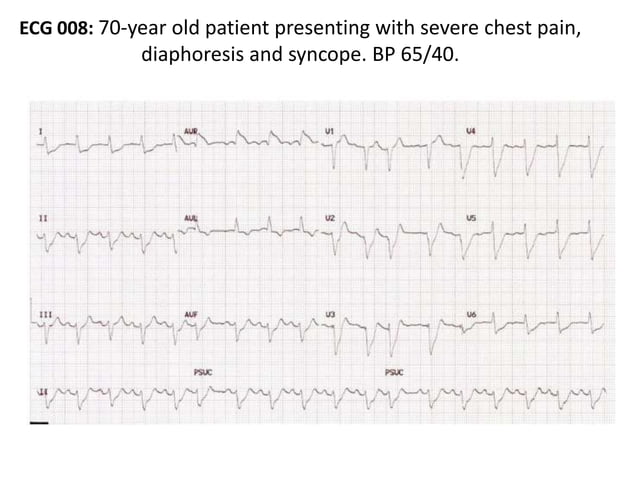 ECG life in the fastlane.pptx | Heart and Cardiovascular Diseases ...