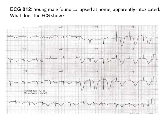 ECG life in the fastlane.pptx | Heart and Cardiovascular Diseases ...