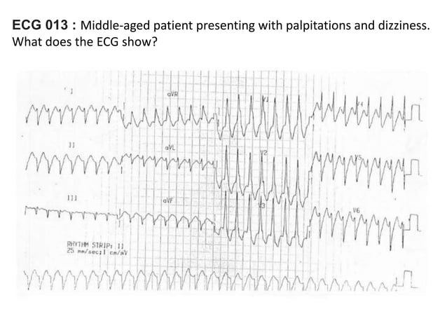 ECG life in the fastlane.pptx | Heart and Cardiovascular Diseases ...