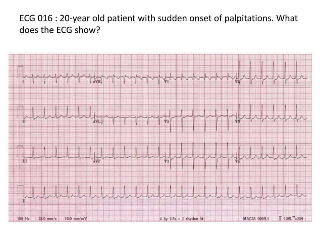 ECG life in the fastlane.pptx | Heart and Cardiovascular Diseases ...