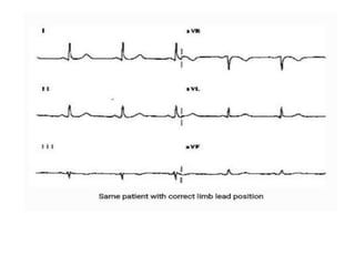 ECG life in the fastlane.pptx