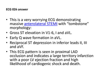 ECG life in the fastlane.pptx