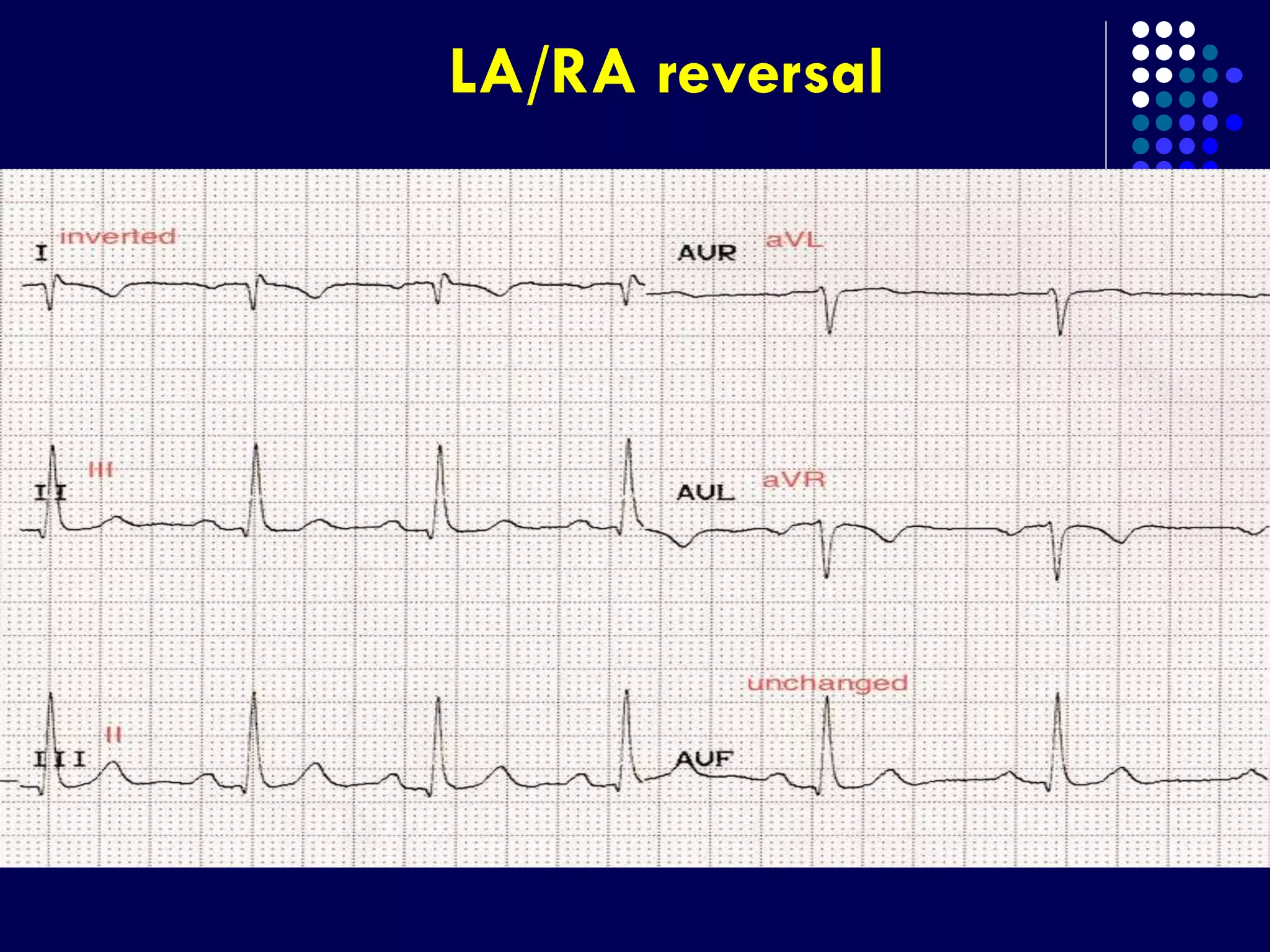 ECG LIMB LEAD REVERSAL | PPTX