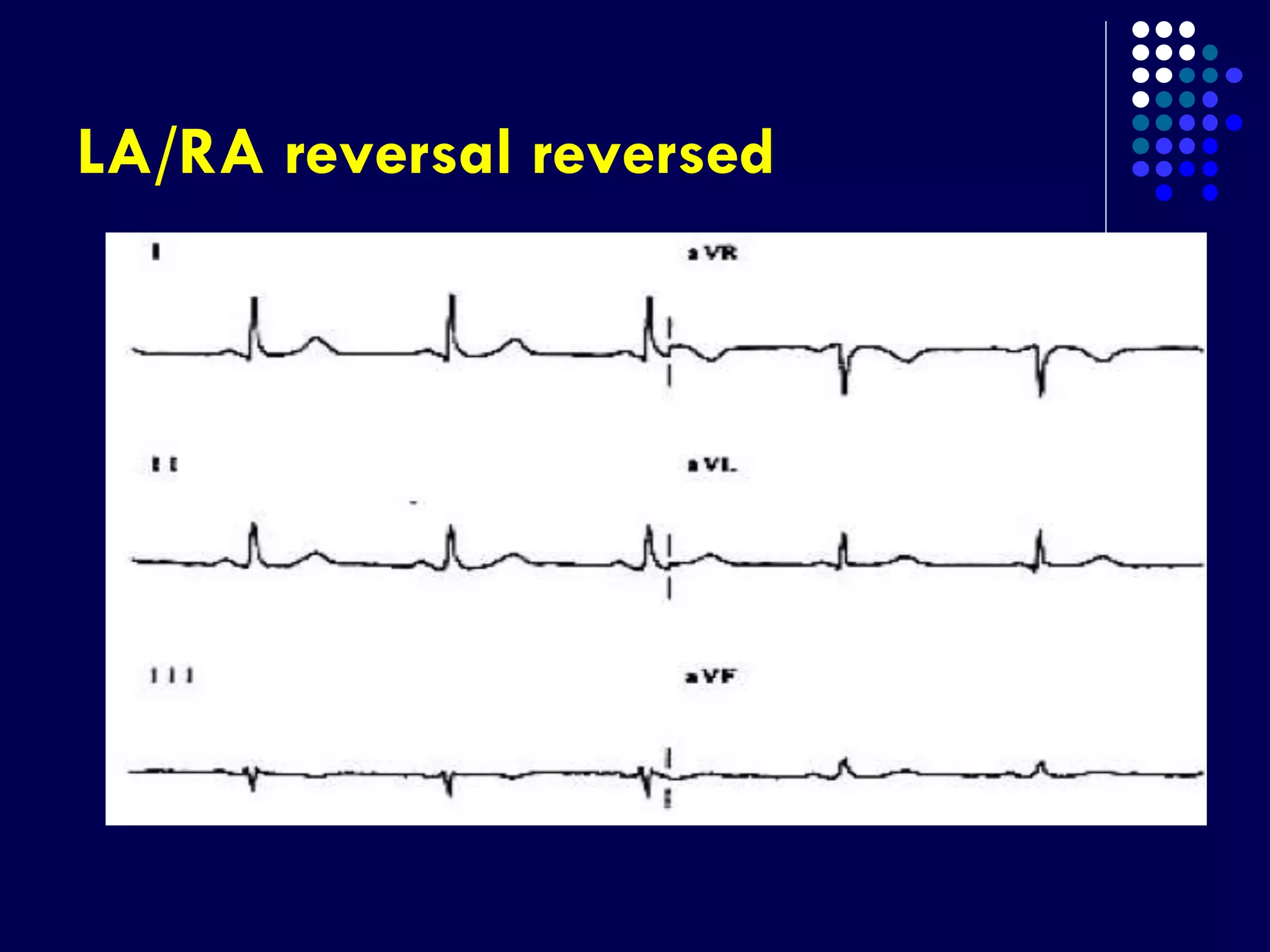 ECG LIMB LEAD REVERSAL