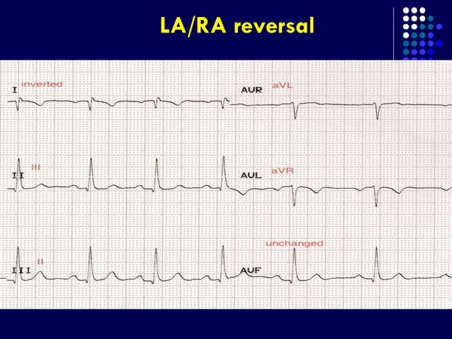 ECG LIMB LEAD REVERSAL | PPTX | Heart and Cardiovascular Diseases ...