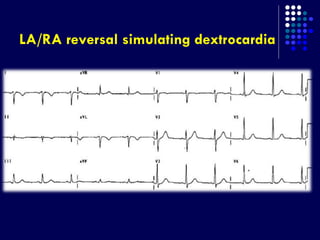 ECG LIMB LEAD REVERSAL | PPTX