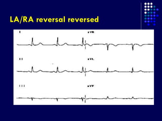 ECG LIMB LEAD REVERSAL | PPTX