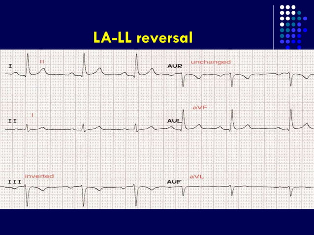 ECG LIMB LEAD REVERSAL | PPTX | Heart and Cardiovascular Diseases ...
