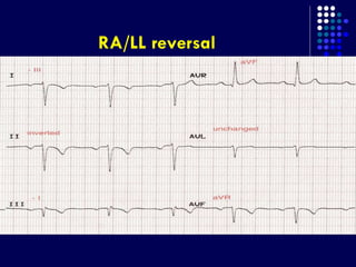 ECG LIMB LEAD REVERSAL | PPTX