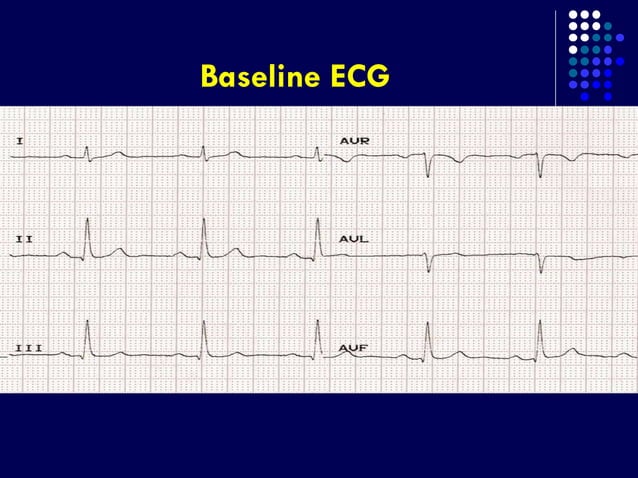 ECG LIMB LEAD REVERSAL | PPTX | Heart and Cardiovascular Diseases ...