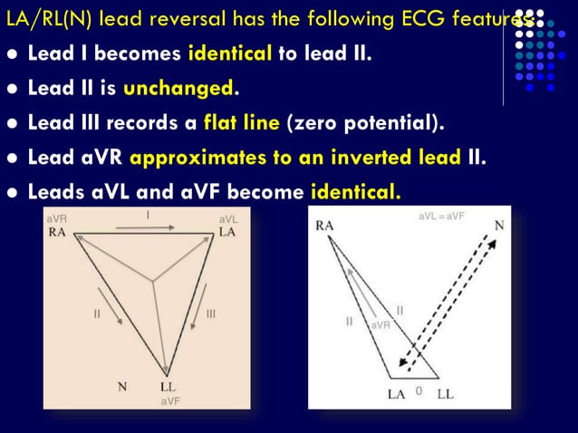 ECG LIMB LEAD REVERSAL | PPTX | Heart and Cardiovascular Diseases ...