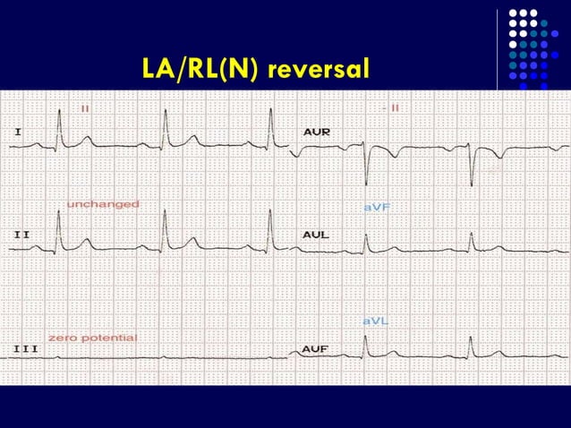 ECG LIMB LEAD REVERSAL | PPTX | Heart and Cardiovascular Diseases ...