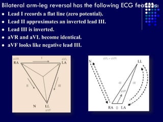 ECG LIMB LEAD REVERSAL | PPTX