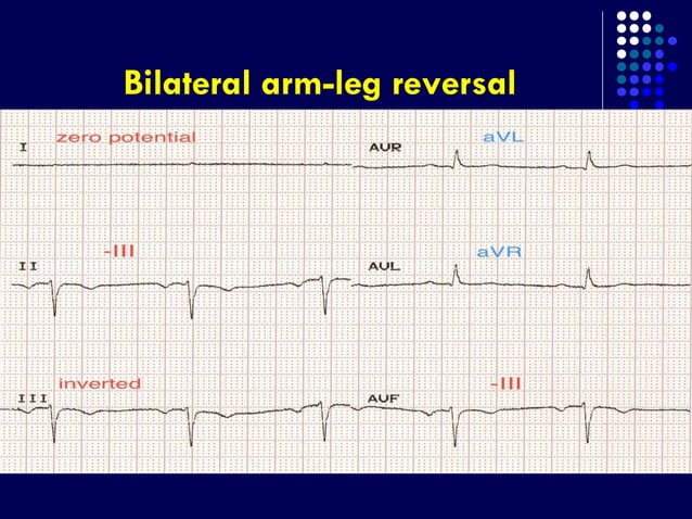 ECG LIMB LEAD REVERSAL | PPTX | Heart and Cardiovascular Diseases ...