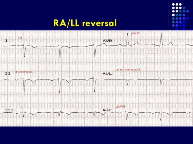 ECG LIMB LEAD REVERSAL