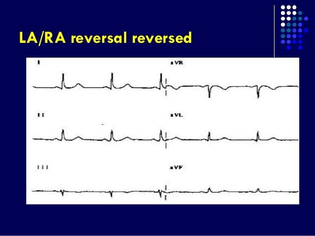 ECG LIMB LEAD REVERSAL
