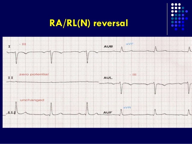 ECG LIMB LEAD REVERSAL