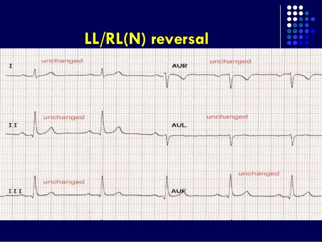 ECG LIMB LEAD REVERSAL