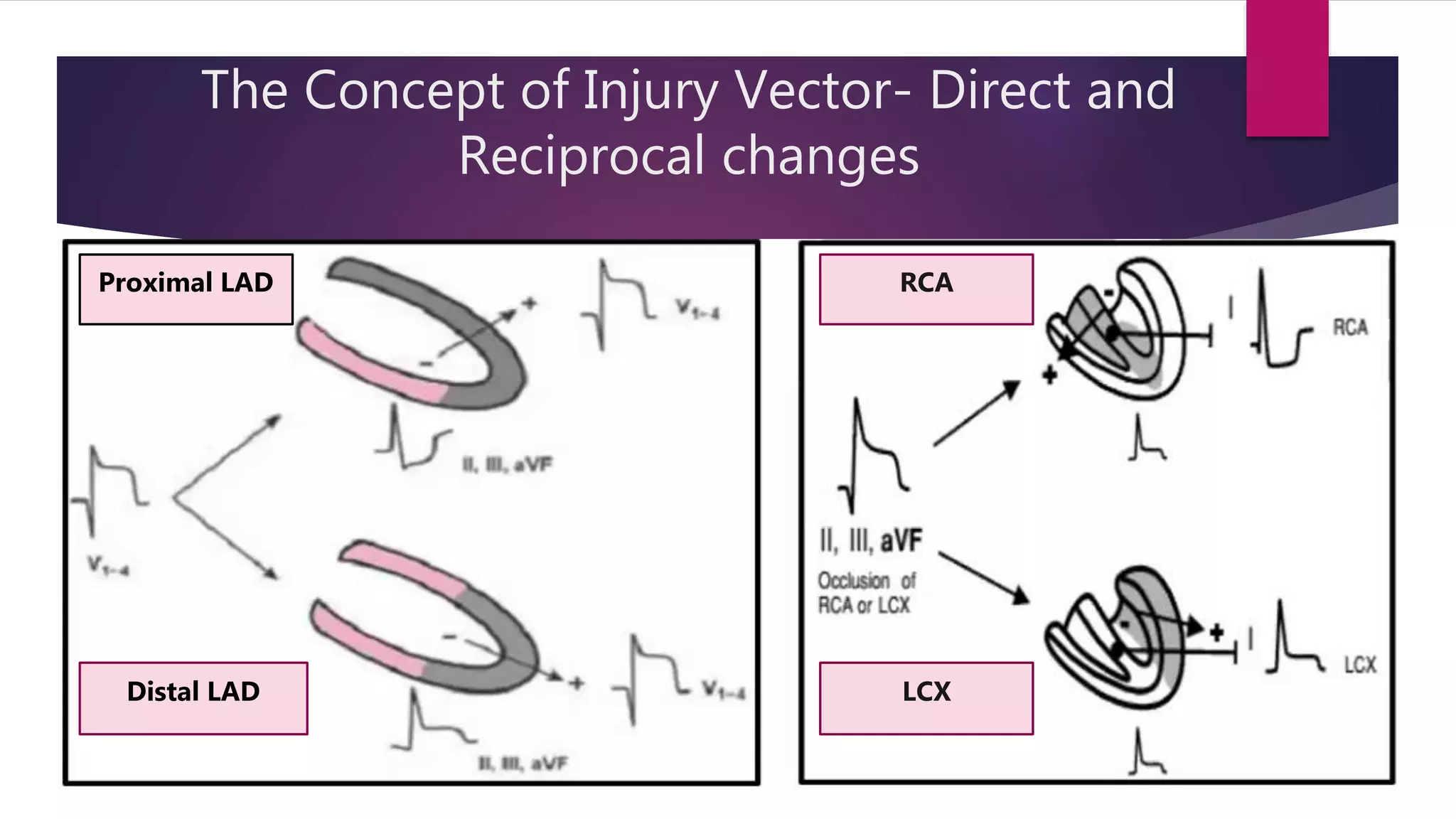 Ecg localization of myocardial infarction | PPTX