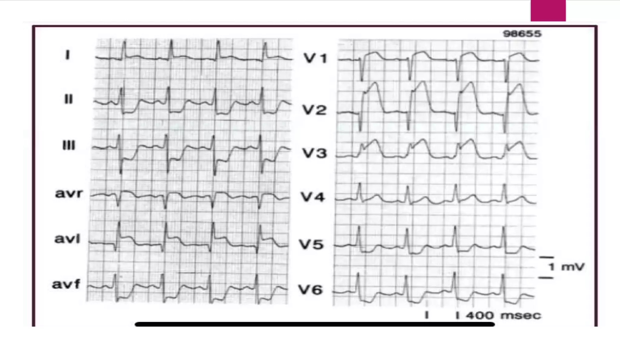 Ecg Localization Of Myocardial Infarction Pptx Heart And Cardiovascular Diseases Diseases