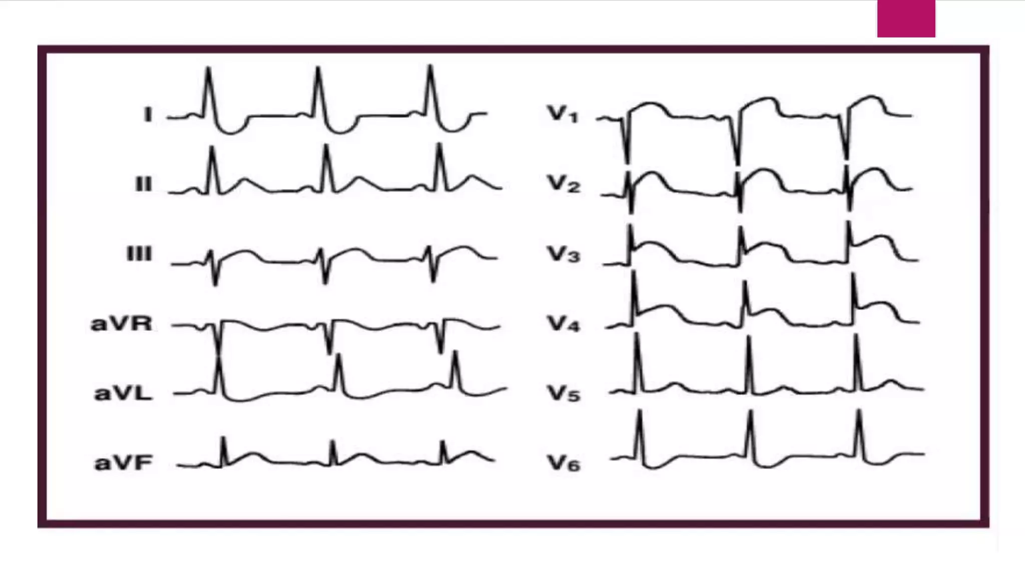 Ecg Localization Of Myocardial Infarction Pptx Heart And