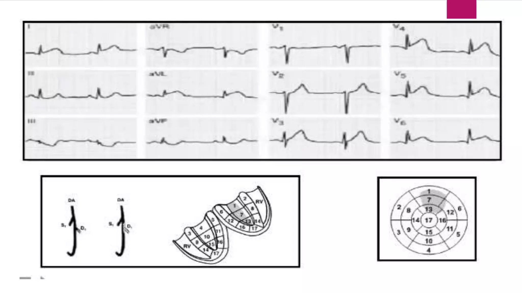 Ecg Localization Of Myocardial Infarction Pptx Heart And