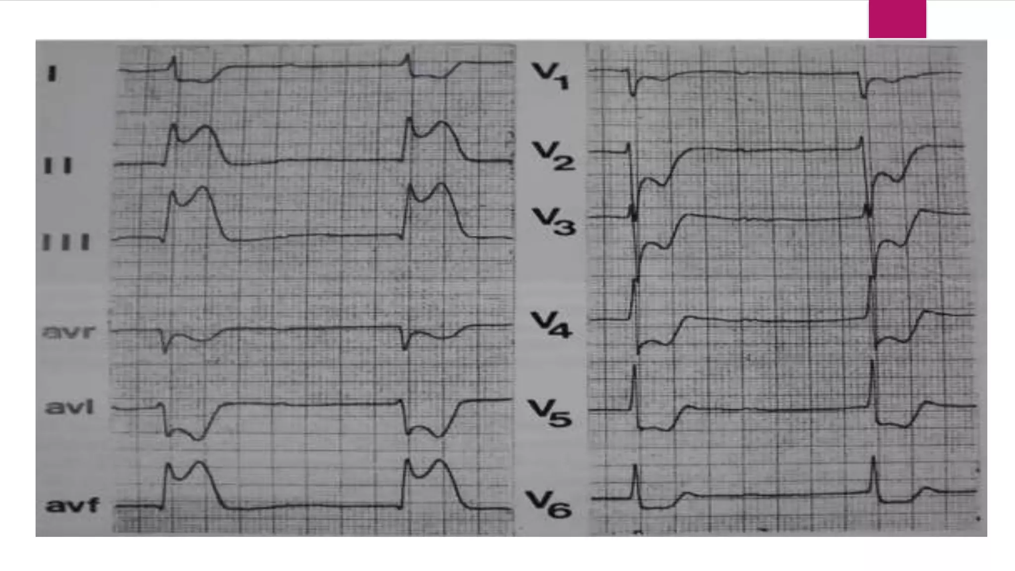 Ecg Localization Of Myocardial Infarction Pptx Heart And