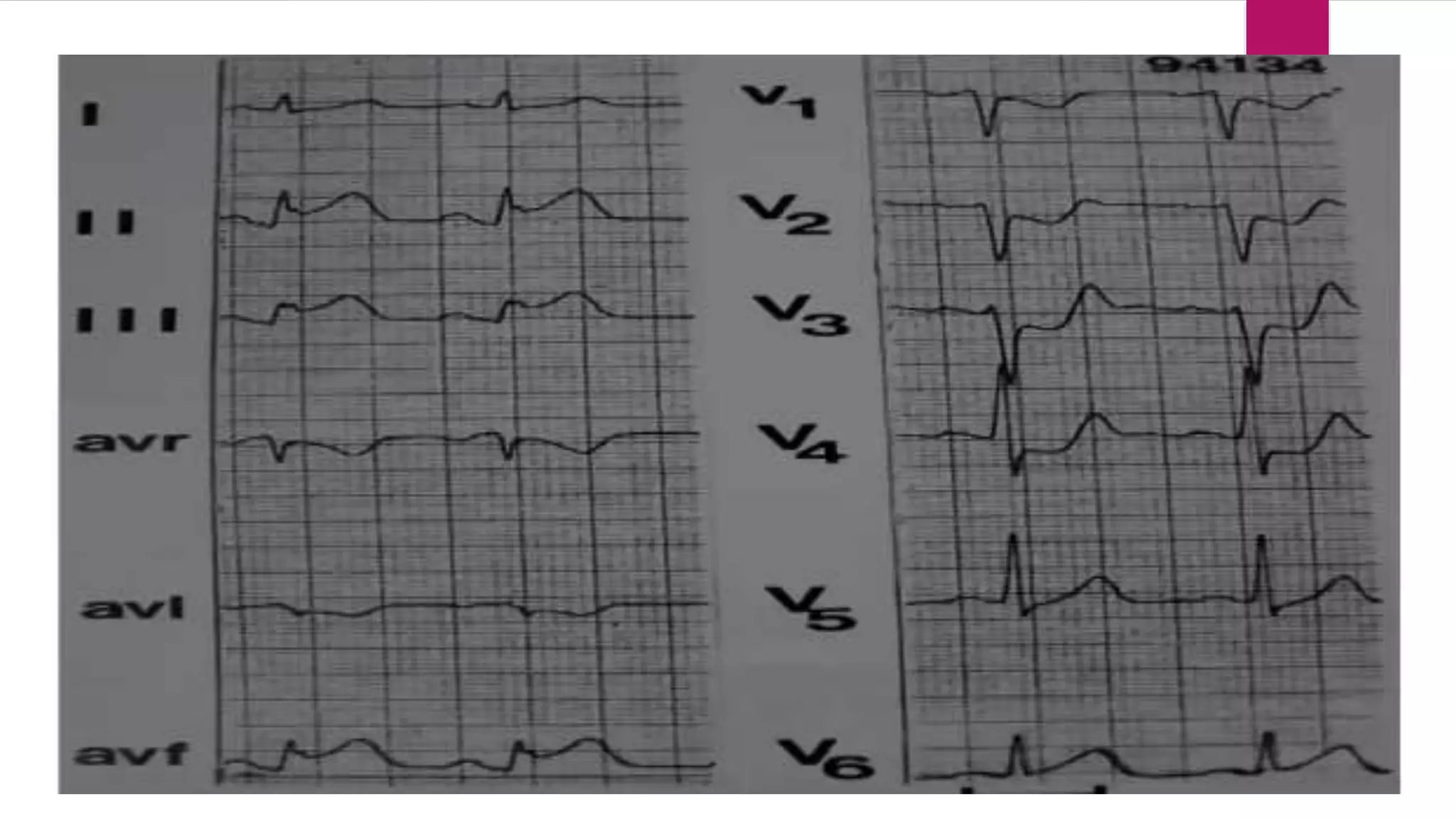 Ecg localization of myocardial infarction | PPTX