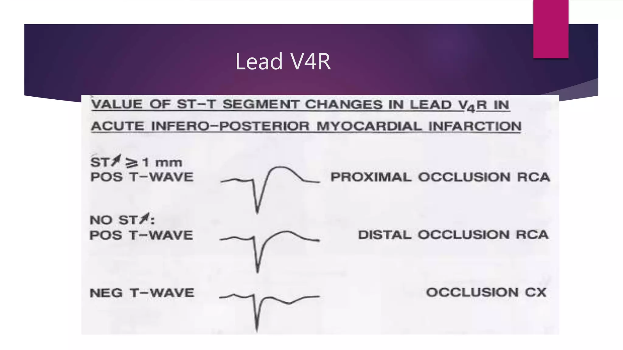 Ecg localization of myocardial infarction | PPTX